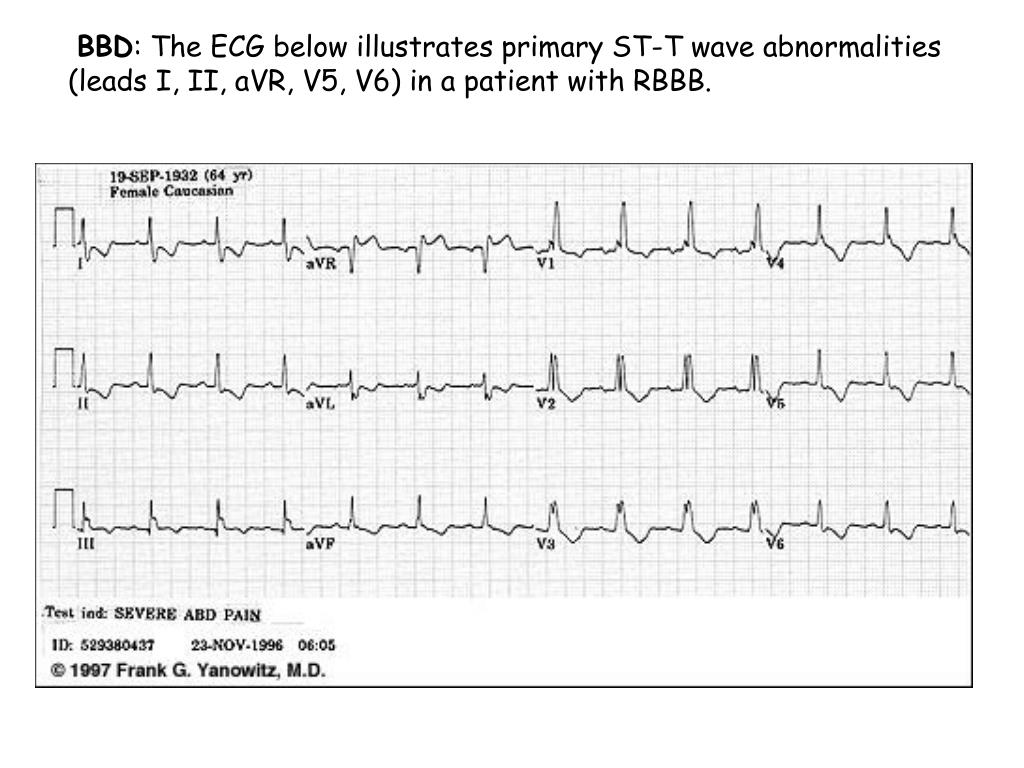 PPT - BLOCCHI ATRIO-VENTRICOLARI (BAV) BAV 1° GRADO (incompleto o ...