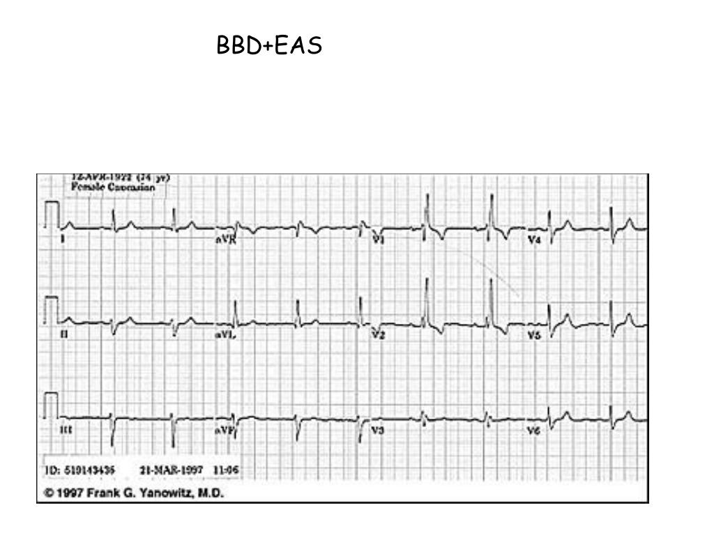 PPT - BLOCCHI ATRIO-VENTRICOLARI (BAV) BAV 1° GRADO (incompleto o ...