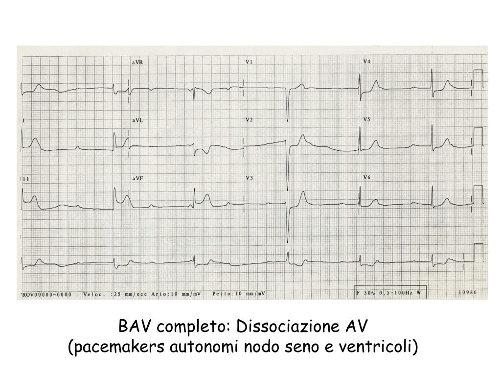 PPT - BLOCCHI ATRIO-VENTRICOLARI (BAV) BAV 1° GRADO (incompleto o ...