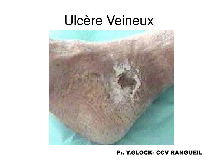 PPT - LA CHIRURGIE des VARICES PowerPoint Presentation - ID:3268295