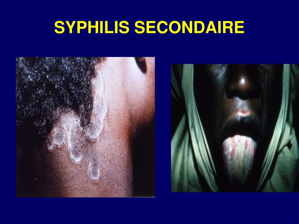 PPT - INFECTIONS SEXUELLEMENT TRANSMISSIBLES PowerPoint Presentation ...