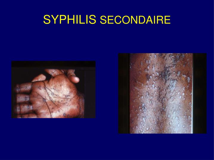 PPT - INFECTIONS SEXUELLEMENT TRANSMISSIBLES PowerPoint Presentation ...