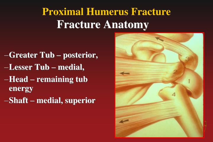 PPT - Proximal Humerus Fractures ORIF & Arthroplasty PowerPoint ...