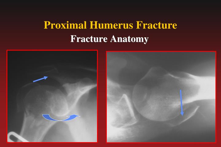 PPT - Proximal Humerus Fractures ORIF & Arthroplasty PowerPoint ...