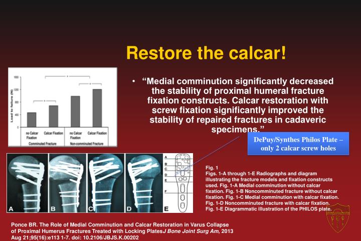 PPT - Proximal Humerus Fractures ORIF & Arthroplasty PowerPoint ...