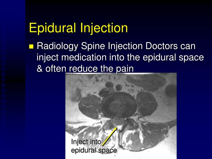 PPT - Epidural Injection PowerPoint Presentation - ID:3269182