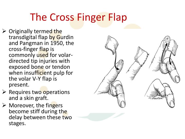 PPT - Flaps in the Hand PowerPoint Presentation - ID:3271054