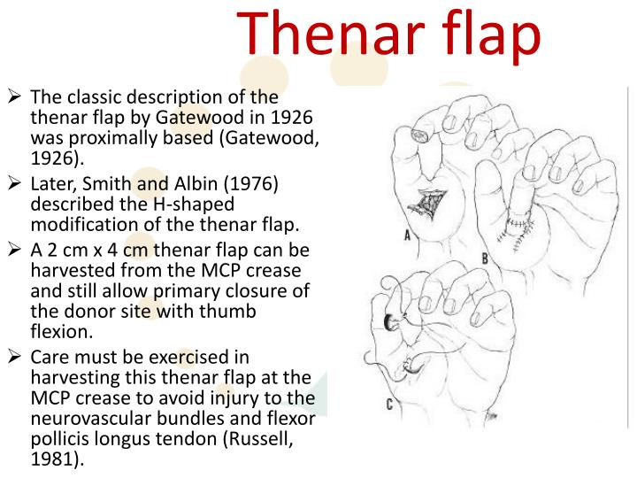 PPT - Flaps in the Hand PowerPoint Presentation - ID:3271054