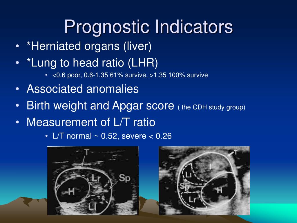 PPT - CONGENITAL DIAPHRAGMATIC HERNIA Dr Osama Bawazir PowerPoint ...