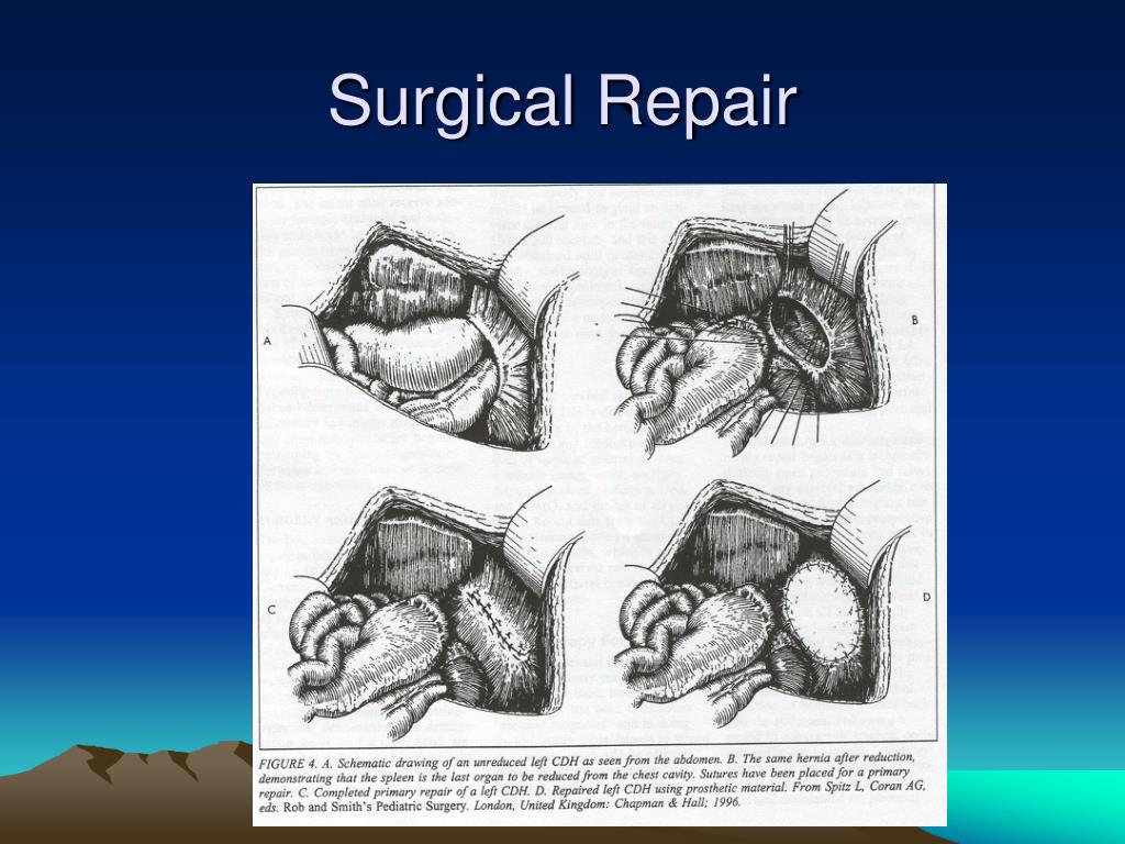 PPT - CONGENITAL DIAPHRAGMATIC HERNIA Dr Osama Bawazir PowerPoint ...