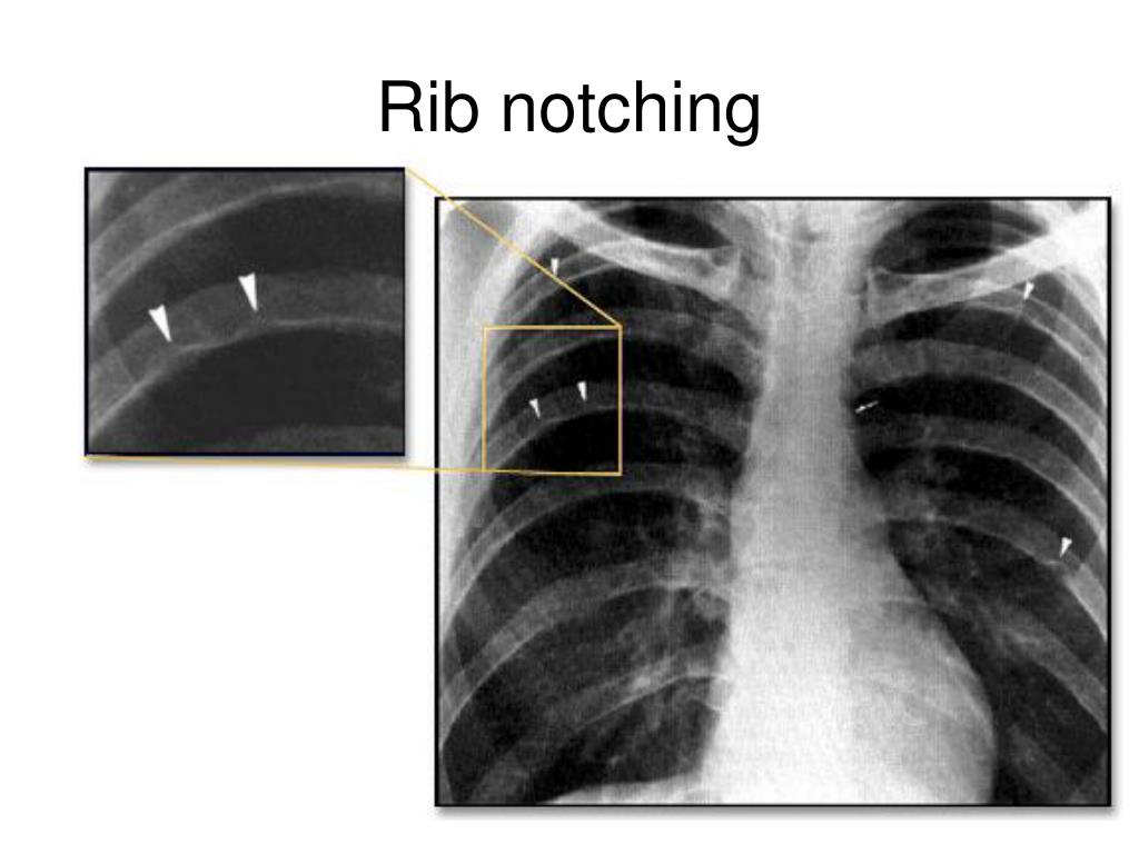 PPT - Adult Congenital Heart Disease PowerPoint Presentation, free ...