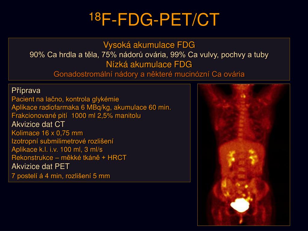 PPT - 18 F-FDG-PET/CT v diagnostice gynekologických nádorů PowerPoint ...