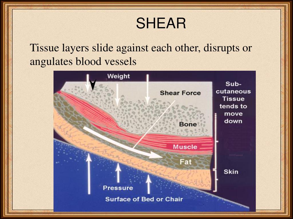 PPT - Pressure Ulcers: Putting Pressure on Prevention Karen Clay, RN ...