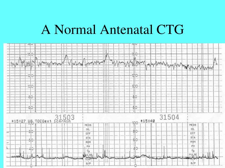 PPT - Understanding Cardiotocography – “CTGs” PowerPoint Presentation ...
