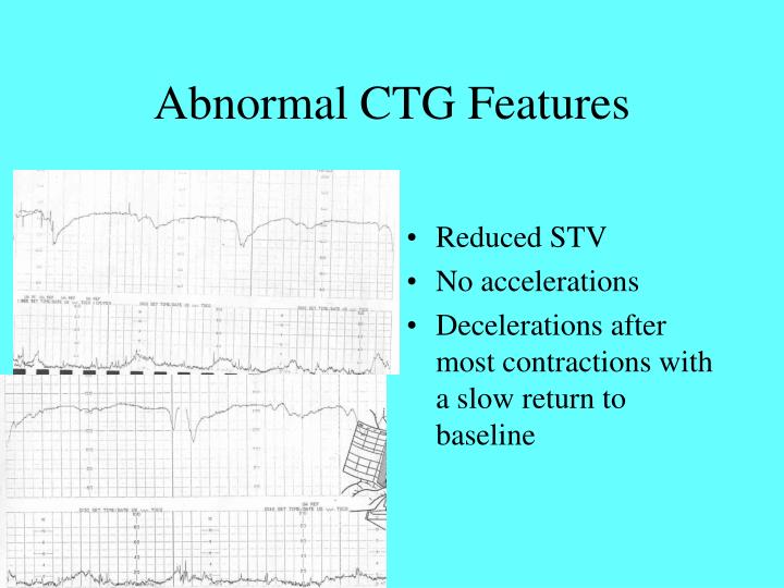 PPT - Understanding Cardiotocography – “CTGs” PowerPoint Presentation ...