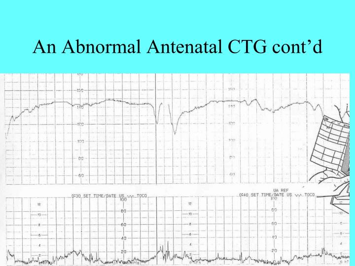 PPT - Understanding Cardiotocography – “CTGs” PowerPoint Presentation ...