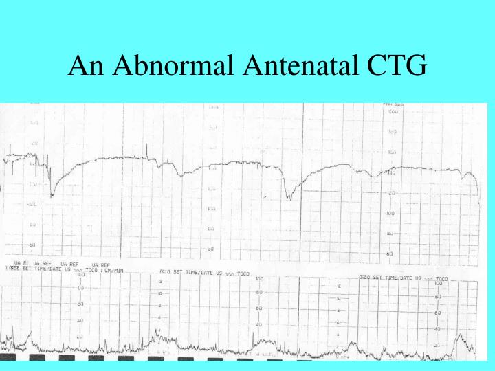 PPT - Understanding Cardiotocography – “CTGs” PowerPoint Presentation ...