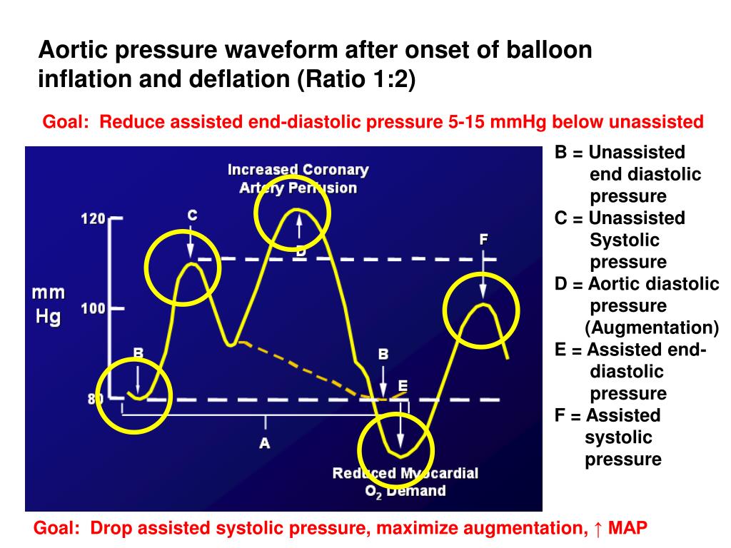 Ppt Intra Aortic Balloon Pumping Powerpoint Presentat - vrogue.co Ppt Intra Aortic Balloon Pumping Powerpoint Presentat - vrogue.co