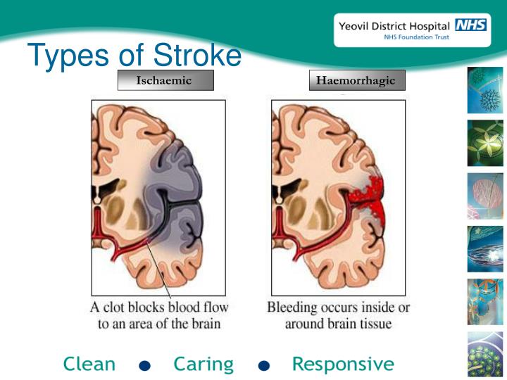 PPT - Stroke diagnosis PowerPoint Presentation - ID:3281000