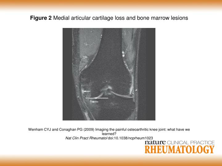 PPT - Figure 2 Medial articular cartilage loss and bone marrow lesions ...