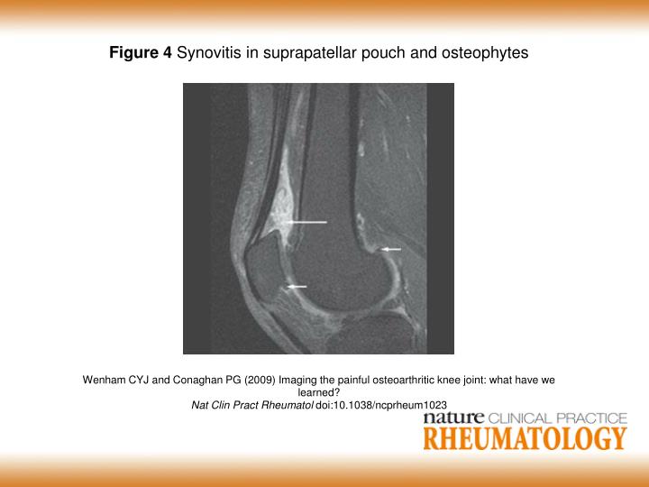 PPT - Figure 4 Synovitis in suprapatellar pouch and osteophytes ...