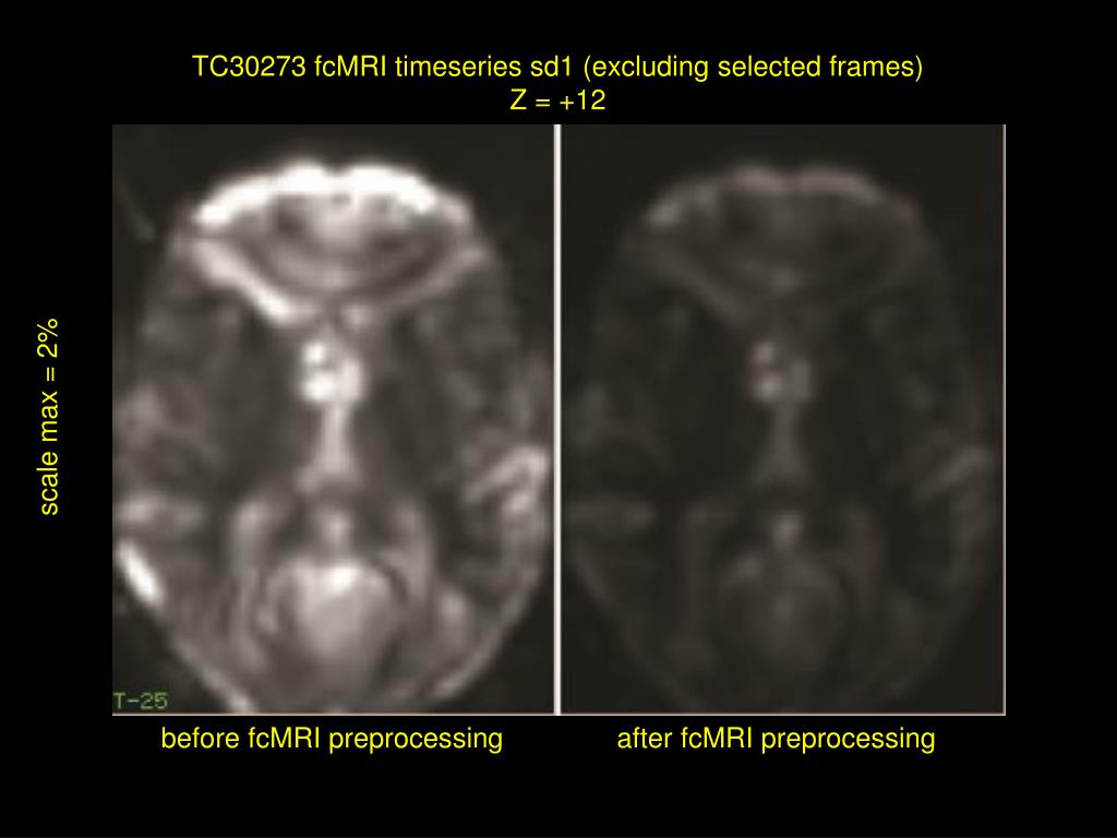 PPT - Resting state fMRI (RS-fMRI; fcMRI) Physiological underpinnings ...