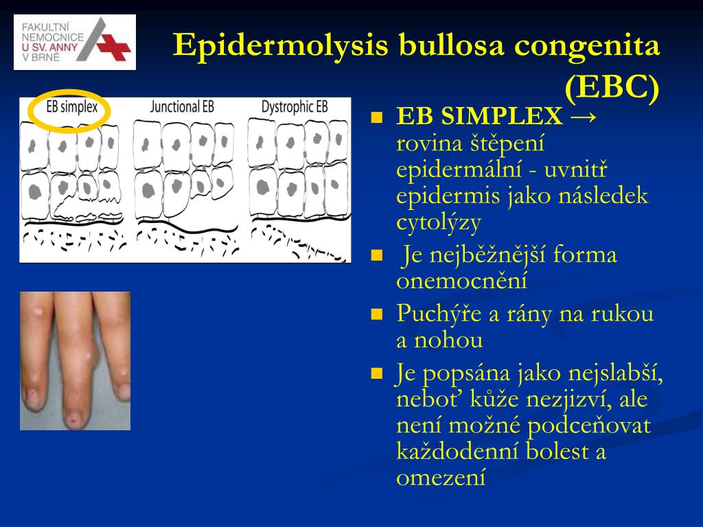 PPT - Antigenní mapping v nemolekulární diagnostice epidermolysis ...