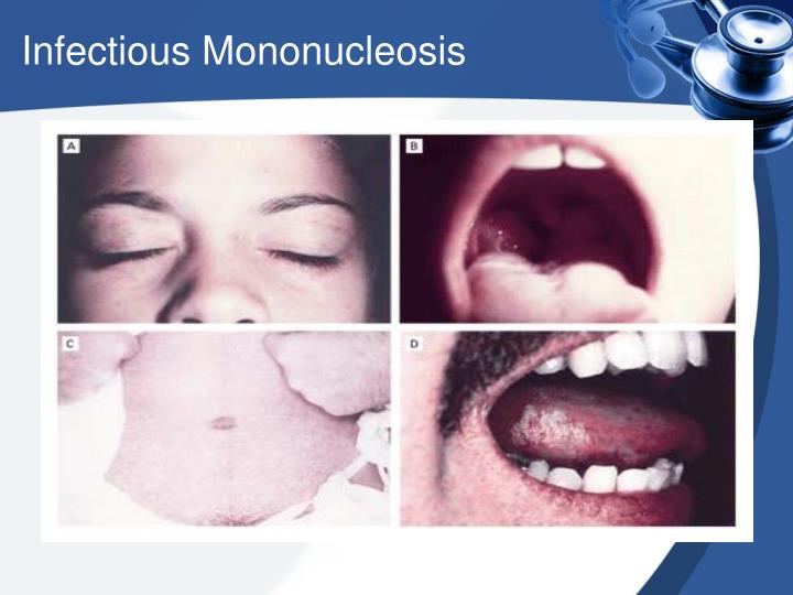 PPT - Infectious Mononucleosis. PowerPoint Presentation - ID:3291291