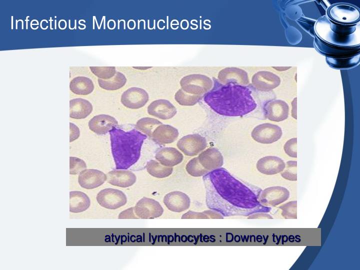 PPT - Infectious Mononucleosis. PowerPoint Presentation - ID:3291291