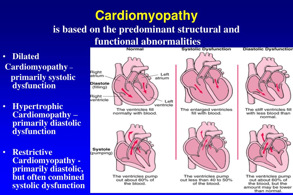 PPT - Nonrheumatic carditis in children. Cardiomyopathy. PowerPoint ...