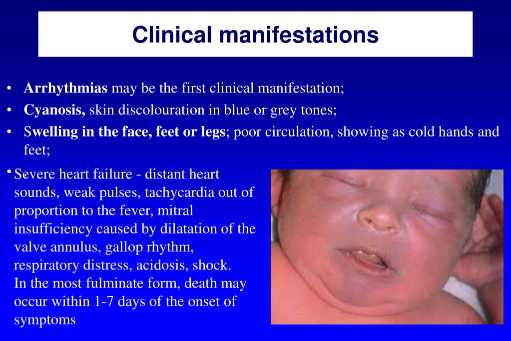 PPT - Nonrheumatic carditis in children. Cardiomyopathy. PowerPoint ...