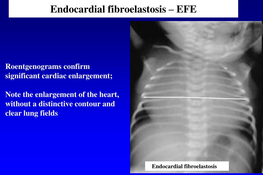 PPT - Nonrheumatic carditis in children. Cardiomyopathy. PowerPoint ...