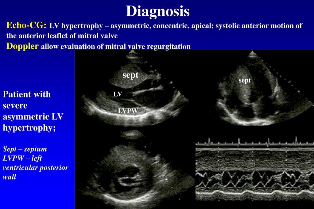 PPT - Nonrheumatic carditis in children. Cardiomyopathy. PowerPoint ...