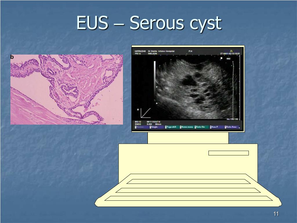 PPT - Differential Diagnosis of Neoplastic Pancreatic Cysts: The Role ...