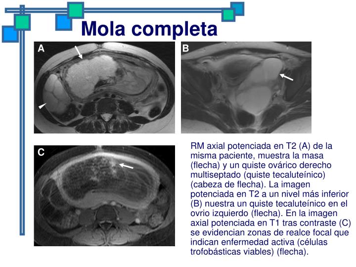 PPT - RM y correlación anatomopatológica en la enfermedad trofoblástica ...