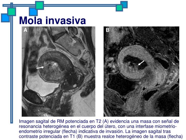 PPT - RM y correlación anatomopatológica en la enfermedad trofoblástica ...