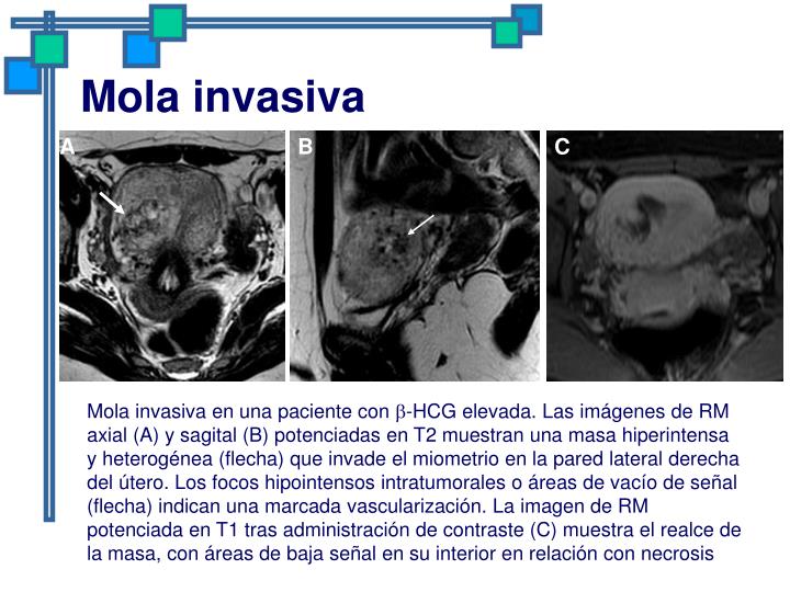 PPT - RM y correlación anatomopatológica en la enfermedad trofoblástica ...