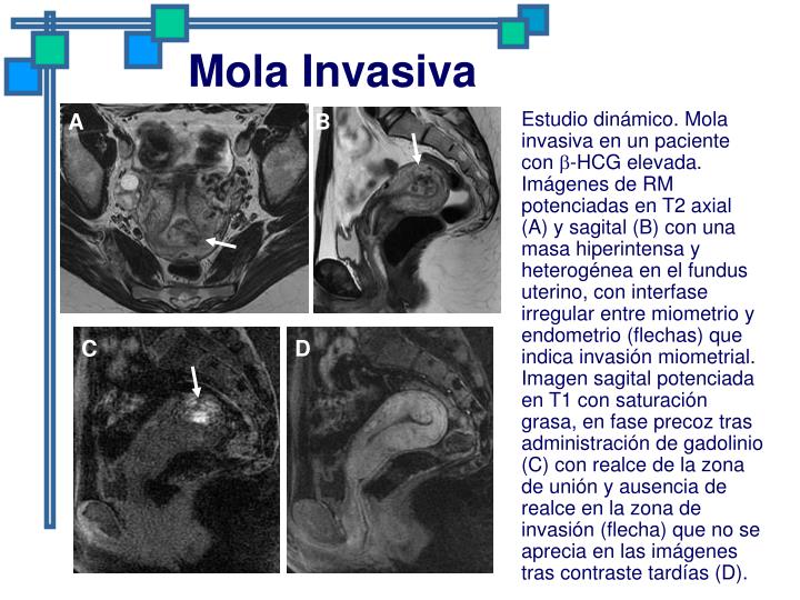 PPT - RM y correlación anatomopatológica en la enfermedad trofoblástica ...
