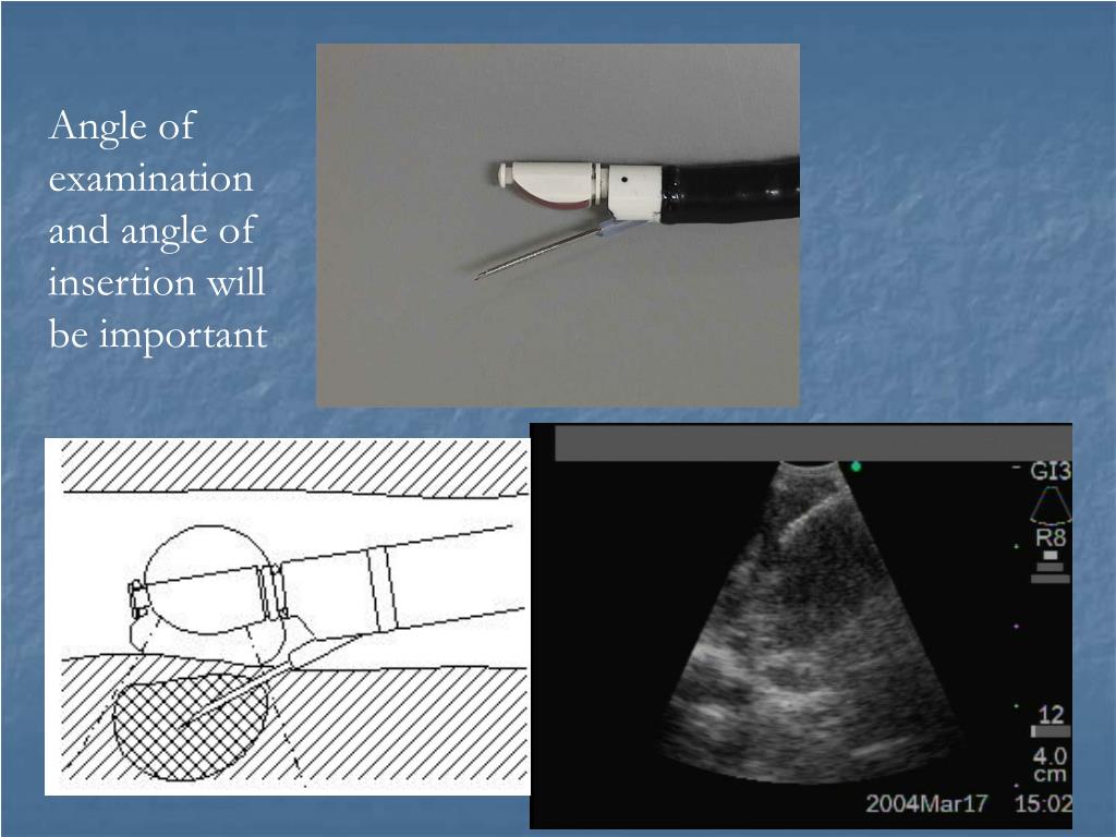 PPT - Endobronchial Ultrasound-Guided Transbronchial Needle Aspiration ...