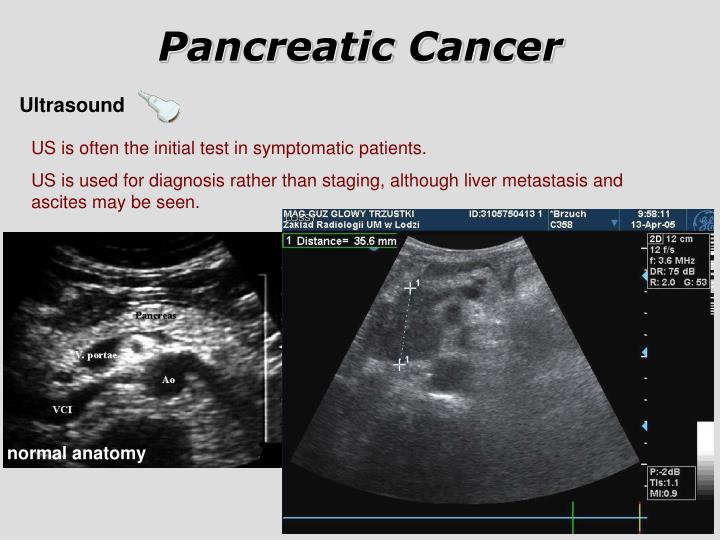 PPT - Pancreatic Cancer PowerPoint Presentation - ID:3295800