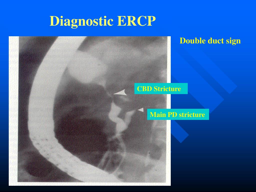 PPT - Pancreatic Cancer: Diagnostic & Maintenance Tools PowerPoint ...