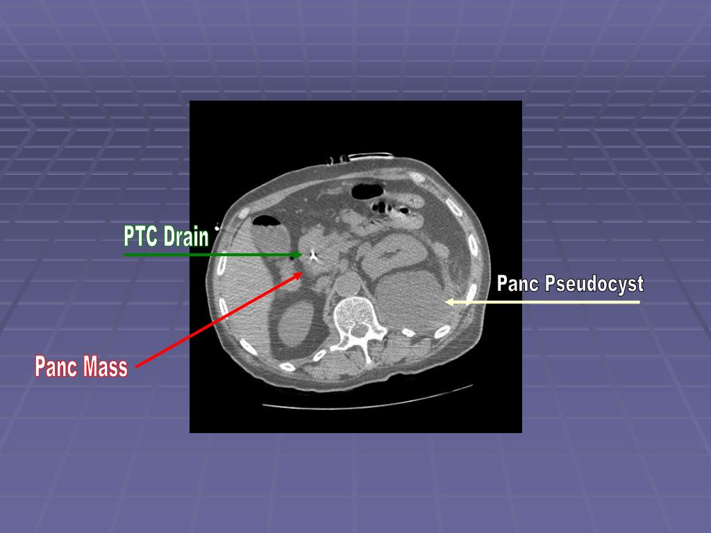 PPT - Endoscopic Ultrasound: Applications in Pre-malignant and ...