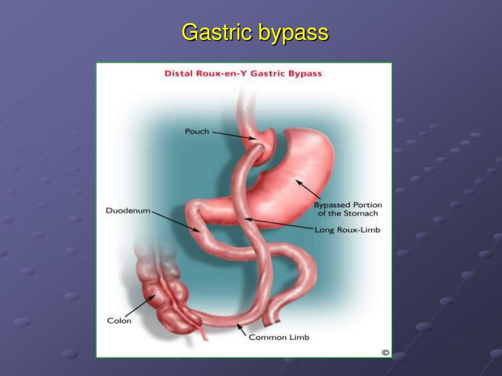 PPT - Chirurgia Bariatrica bypass gastrico laparoscopico PowerPoint ...
