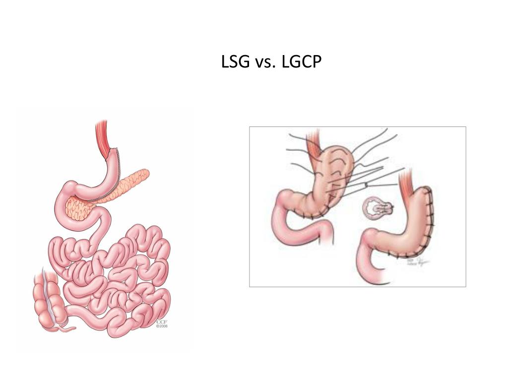PPT - Phil Schauer, MD Bariatric and Metabolic Institute PowerPoint ...