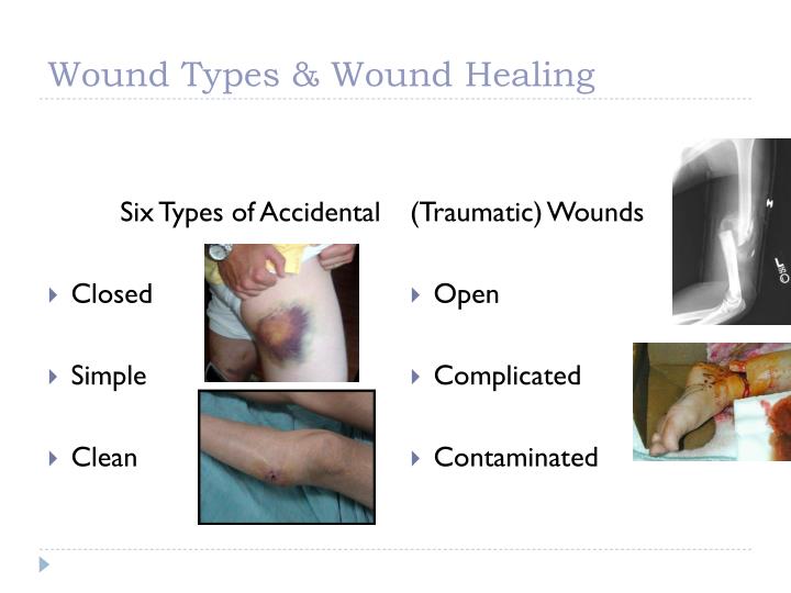 PPT - Wound Healing, Wound Types, Wound Dressings, & Drainage Devices ...
