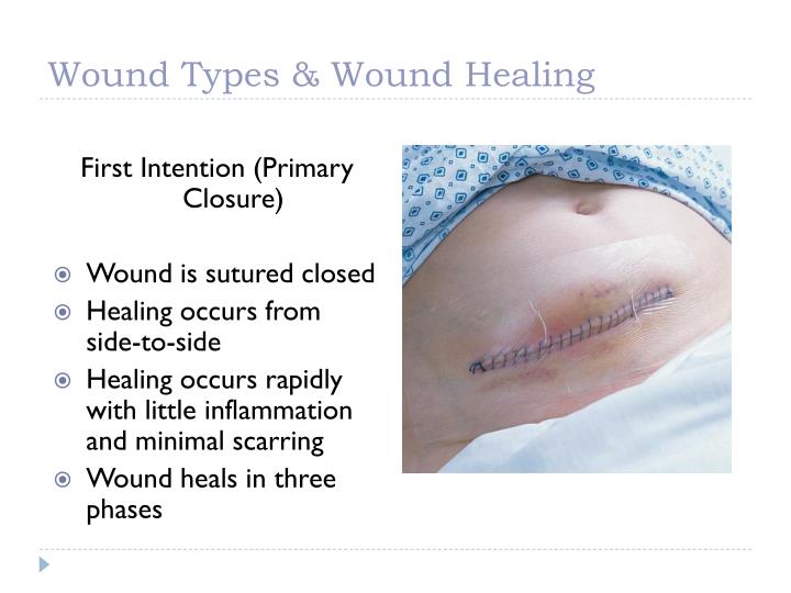 PPT - Wound Healing, Wound Types, Wound Dressings, & Drainage Devices ...