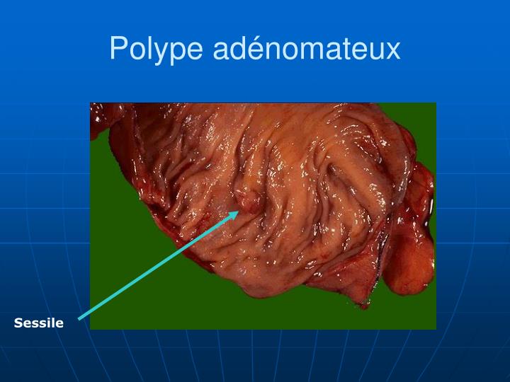 PPT - Cancer Colo-rectal PowerPoint Presentation - ID:3297679
