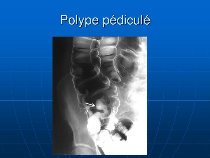 PPT - Cancer Colo-rectal PowerPoint Presentation - ID:3297679