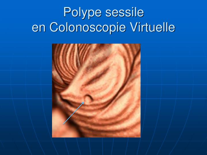 PPT - Cancer Colo-rectal PowerPoint Presentation - ID:3297679