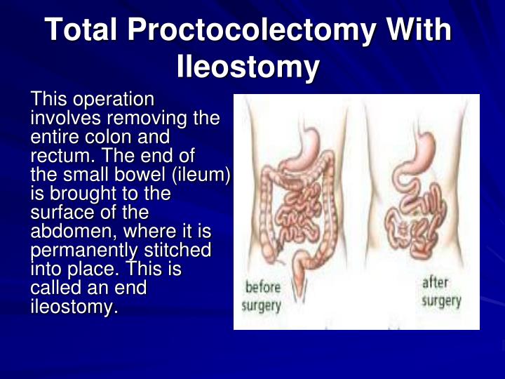PPT - Colon cancer PowerPoint Presentation - ID:3297970